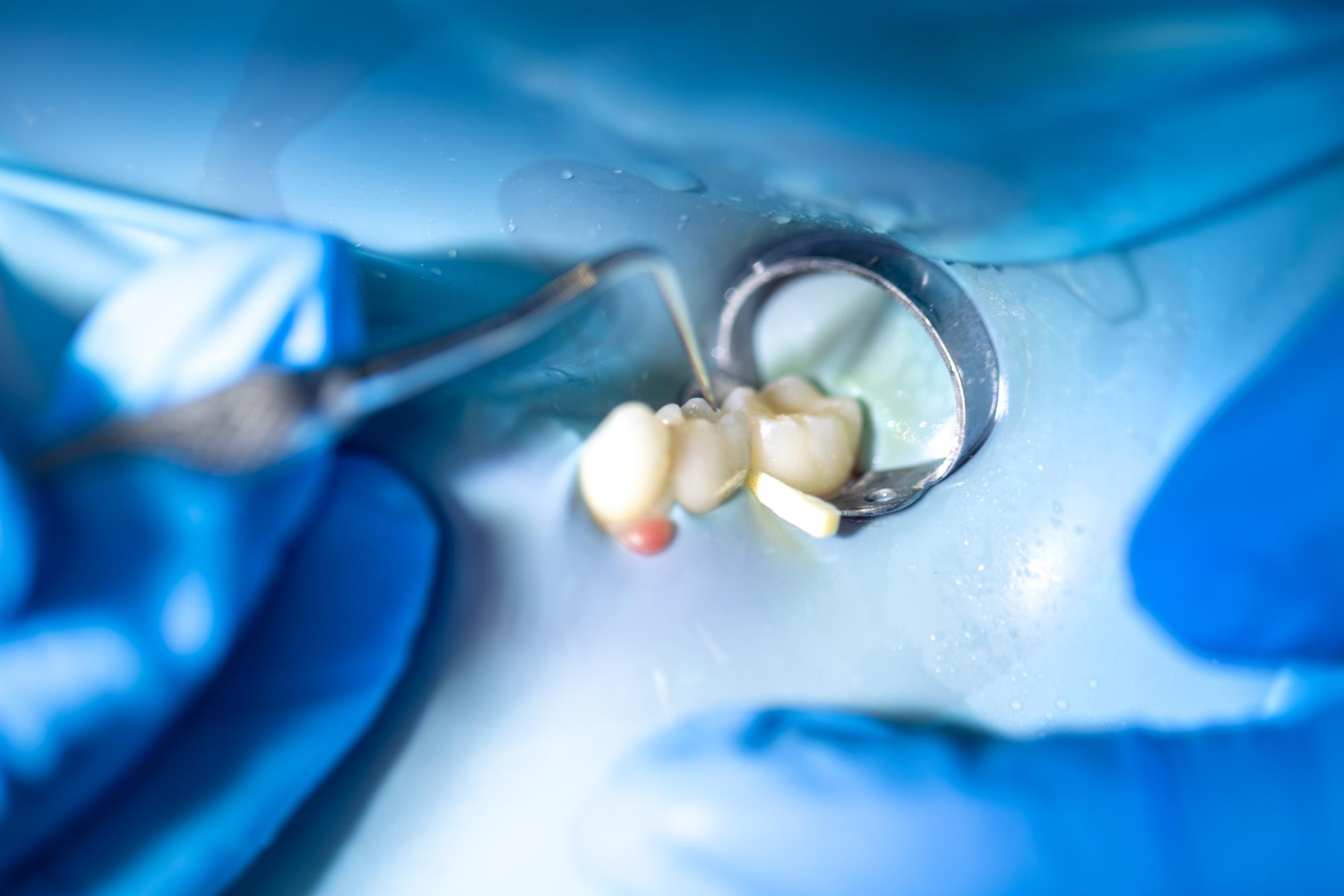 Wisdom Teeth Surgery Prep: Instructions & Tips